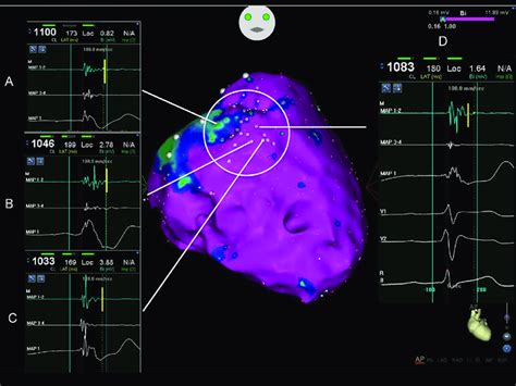Measurements Of Prolonged Electrogram Timing With Annotation At Bipolar Download Scientific