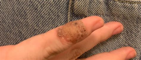 Treatment Resistant Wart Rwarts