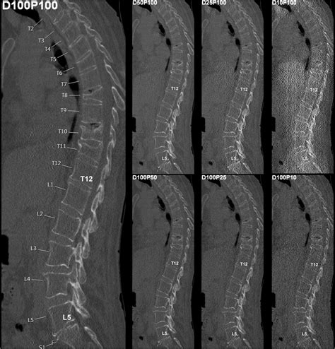 Virtual Tube Current Reduction And Sparse Sampling In Multidetector Ct Download Scientific