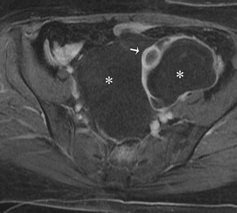 Mri Of Tumors And Tumor Mimics In The Female Pelvis Anatomic Pelvic Hot Sex Picture