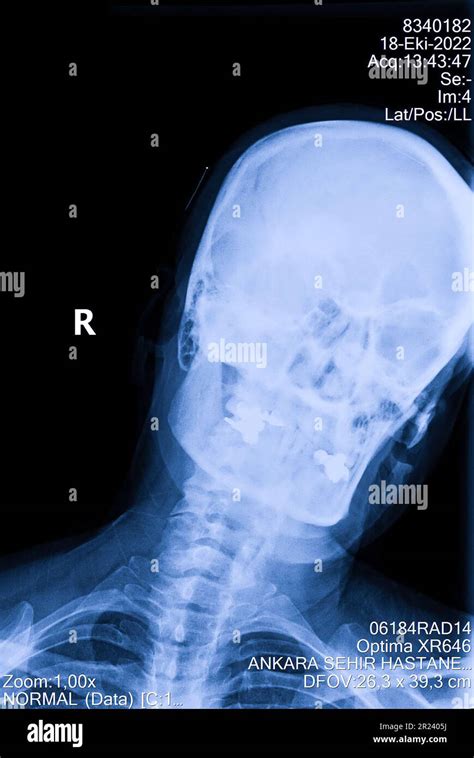 Woman S Cervical Spine X Ray Human Neck Radiography Stock Photo Alamy