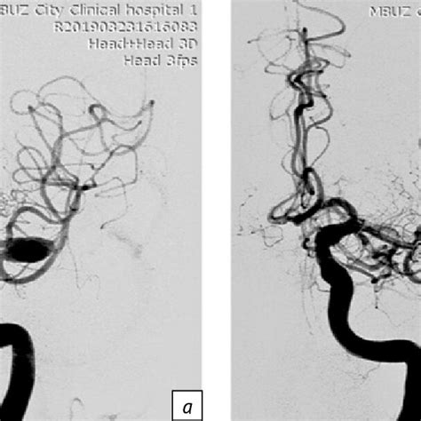 Cerebral Angiograms A Saccular Aneurysm Of The M1 M2 Segment Of The Download Scientific