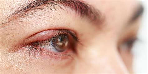 Can You Get Pimples On Eyelids How To Spot And Treat A Stye