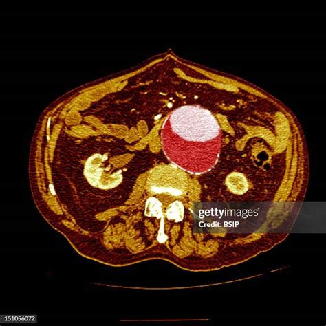 Vascular Calcification Photos And Premium High Res Pictures Getty Images