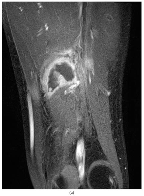 Open Sciatic Nerve Decompression For Compartment Syndrome After