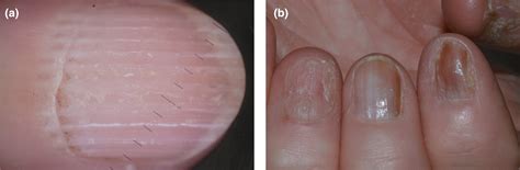 Alopecia Areata Nails