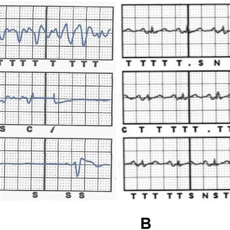 The S Icd Provides Three Distinct Sensing Vectors For Arrhythmia Download Scientific Diagram