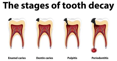 55 Stages Of Tooth Decay Stock Illustrations Depositphotos