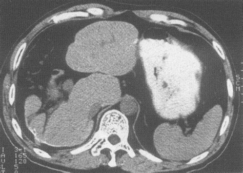 例27 慢性血吸虫性肝病肝硬化 特种医学 医学