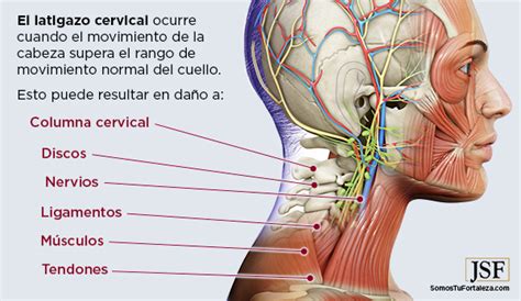 Latigazo Cervical Contra La Mujer De Hierro