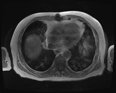 Cholangiocarcinoma Hilar Type Radiopaedia 59780 67206 Axial T1 In Phase Nc Commons