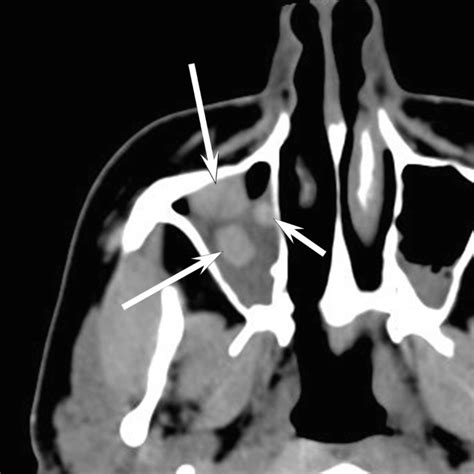 Radiologic Imaging Of Nasal Polyposis Springerlink