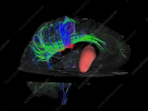 Brain Tumour DTI MRI Scan Stock Video Clip K Science Photo Library