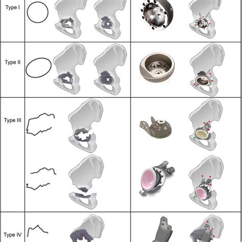 Acetabular Defect Classification And Management Based On 3 Point