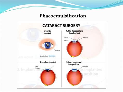Cataract Seminar Presentation With Pathophysiology Pdf