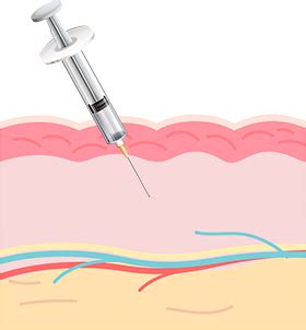 JUVELOOK 再生 胶原蛋白针 皮肤 UPIC