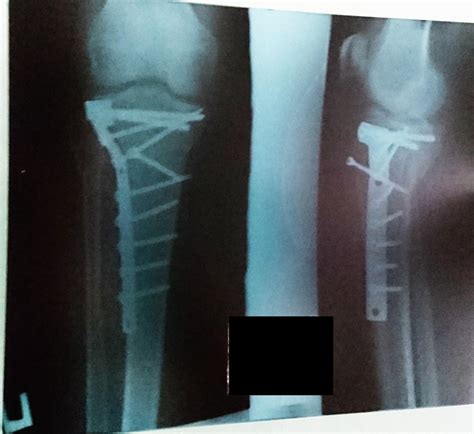 Broken Tibia Fixed R XRayPorn