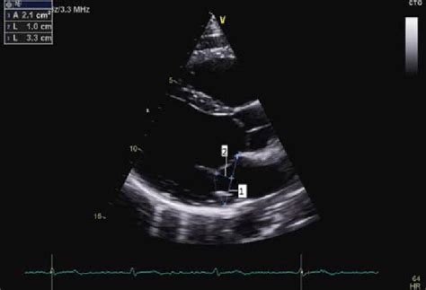 Parasternal Long Axis View Demonstrating Measurements Of The Mitral
