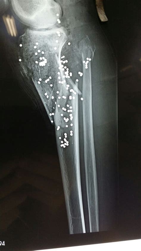 Proximal Third Tibia Fracture Trauma Orthobullets