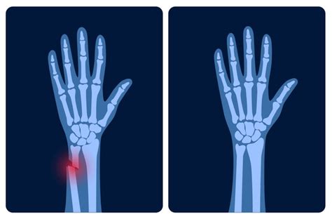 Human Broken Arm X Ray