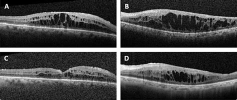 Intravitreal Injections For Macular Edema In Silicone Oil Filled Eyes
