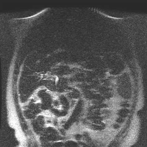 Mrcpcoronal Planet2ssfse Experimental Negative Spio Oral Solution