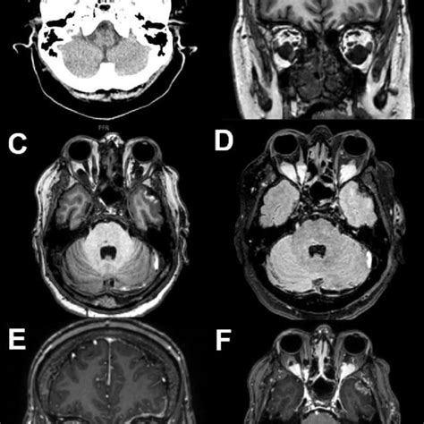 Venous Varices Ct And Mri Of A Patient With Bilateral Orbital Venous Download Scientific