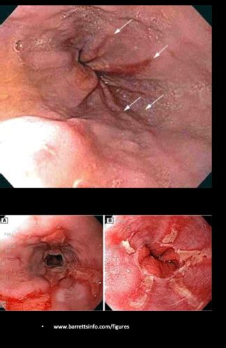 L23 Upper Gi Diseases Flashcards Quizlet