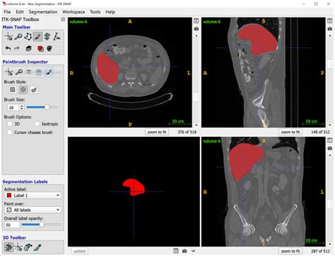Software To Visualizeannotate Dicomnifti Files Pycad Your Medical Imaging Partner