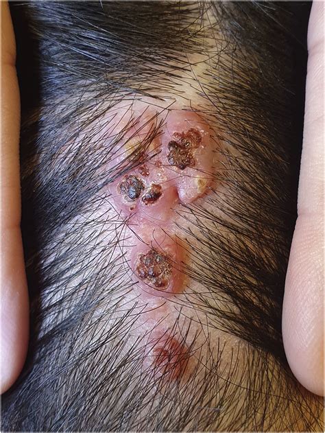 Syringocystadenoma Papilliferum In The Scalp With A Linear Presentation Anais Brasileiros De