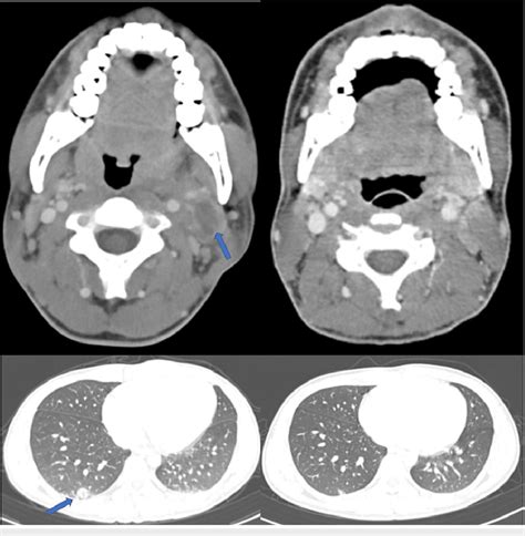 Serial Computed Tomography Ct Findings Left Contrast Enhanced Download Scientific Diagram