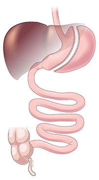 Weight Loss Surgery Types And Procedures Near You Summa Health