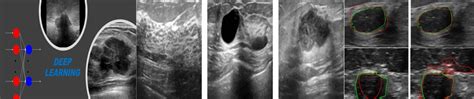 Breast Ultrasound Images Dataset Kaggle