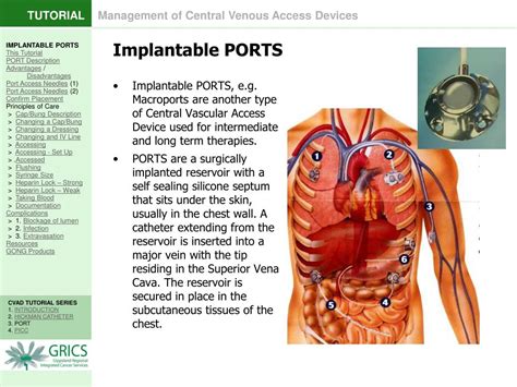 Ppt 3 Implantable Ports Powerpoint Presentation Free Download Id