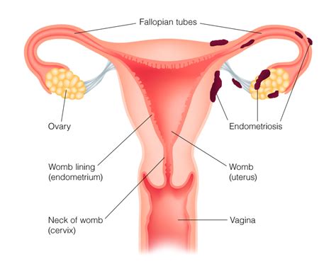 Pouch Of Douglas Endometriosis