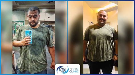 علاج السمنة في تركيا أمل جديد لحياة صحية زووم كلينك للتجميل في تركيا