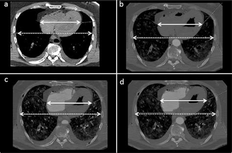 Measurement Of The Cardiothoracic Ratio With The Maximum Cardiac