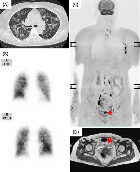 Figure1a Contrast Enhanced Chest Ct Revealing Diffuse Patchy