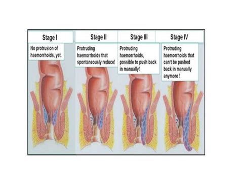 Hemorrhoid Pptx Digestive Disorders Diseases And Conditions