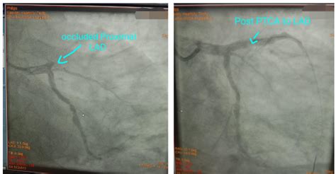 STEMI EQUIVALENT BUT STEMI Kauvery Hospital