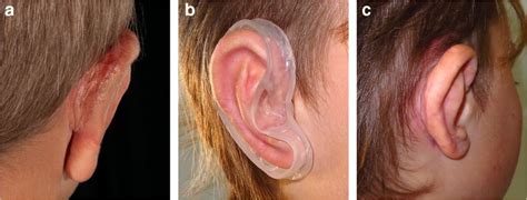 Ear Splinting A Obliteration Of The Retroauricular Sulcus Due To Skin Download Scientific