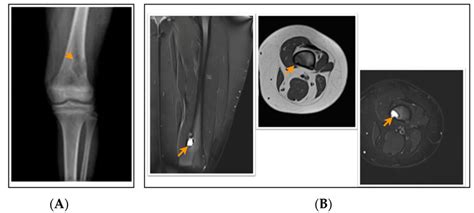 A 12 Year Old Patient With A Fibrous Cortical Defect Around The Knee