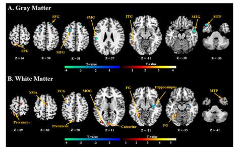 Figure 3 From Multimodal Neuroimaging Predictors Of Learning Performance Of Sensorimotor Rhythm