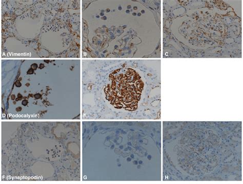 Immunohistologically Detached And Capillary Attached Podocytes Were Download Scientific