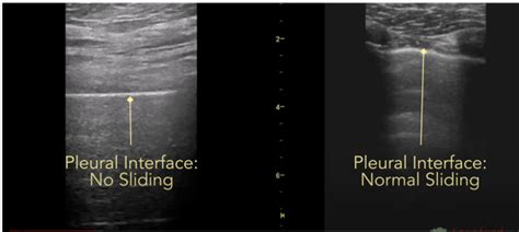 Lung Ultrasound A Comprehensive Guide Stanford Medicine 25