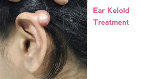 Keloids On Ears