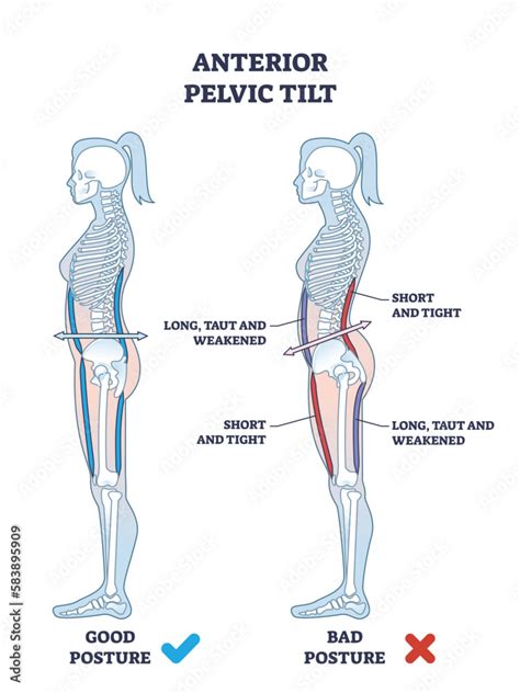 Photo Anterior Pelvic Tilt Or Apt As Pelvis Abnormal Posture Outline