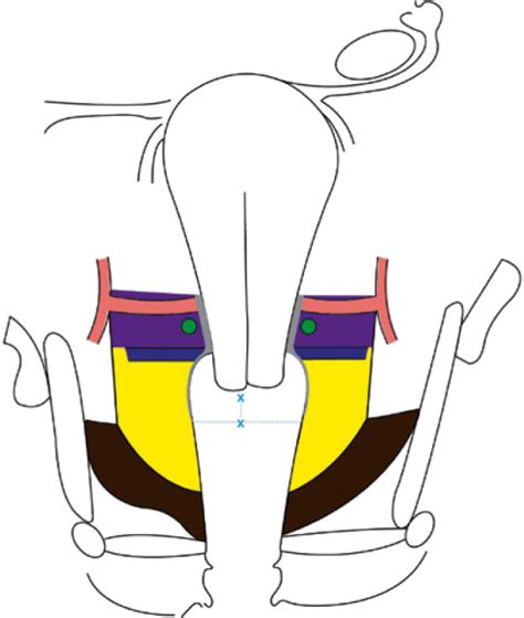 Understanding The Limits Of Parametrial Resection In Radical