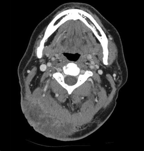reconstruction of cervical necrotizing fasciitis defect with the