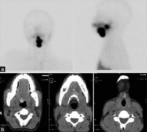 Endocrine Thyroid Development Embryology